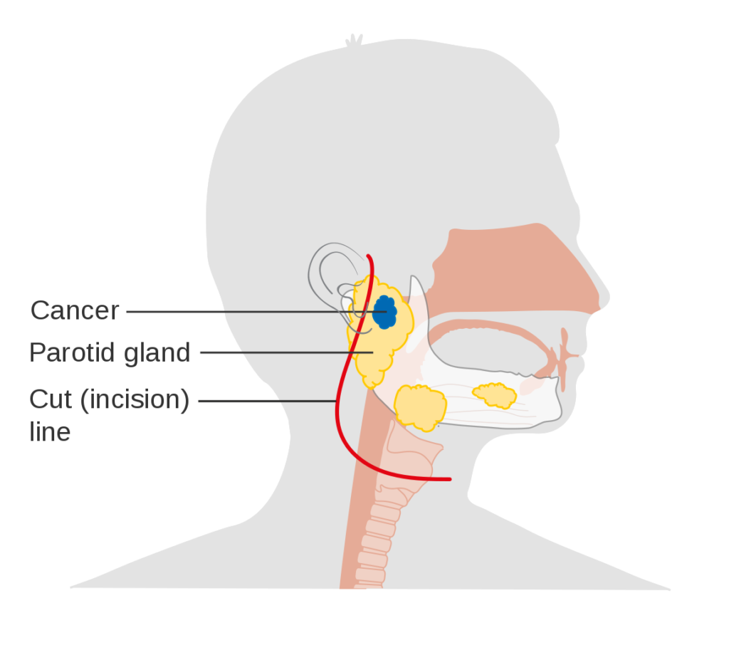 Specialist of Parotid Surgery Dubai