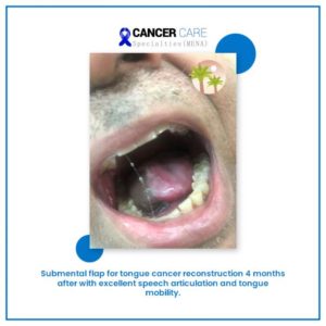 Submental flap for tongue cancer reconstruction 4 months after with ...
